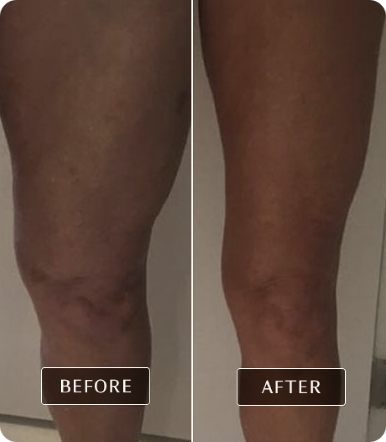 Cellulite Before & After Results | Ashley Black Fascia Blaster