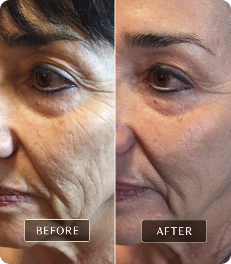 Fascia Blaster Before And After Face