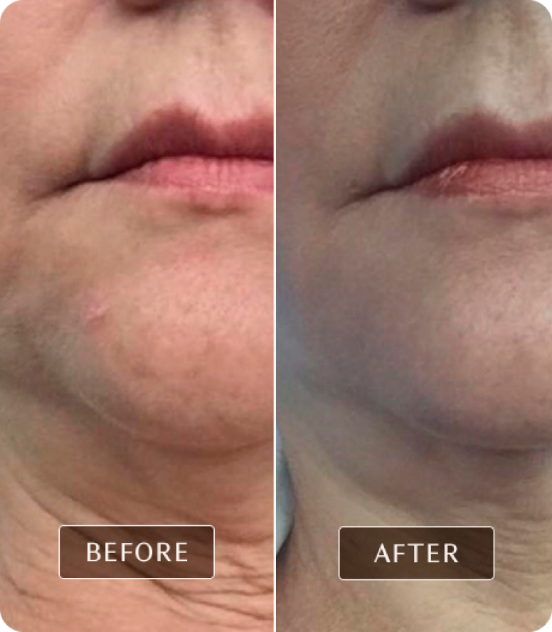 Jaw & Neck Before and After Results | Ashley Black