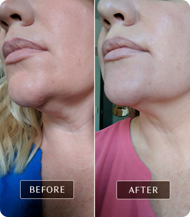 Jaw & Neck Before and After Results | Ashley Black