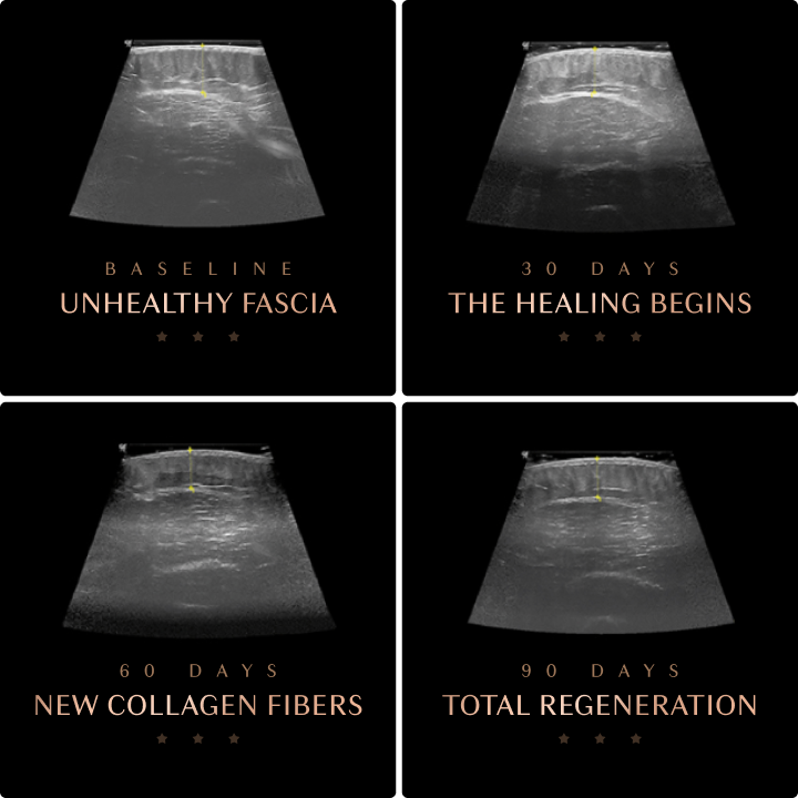 Fascia Recovery for Athletes & Active Lifestyles