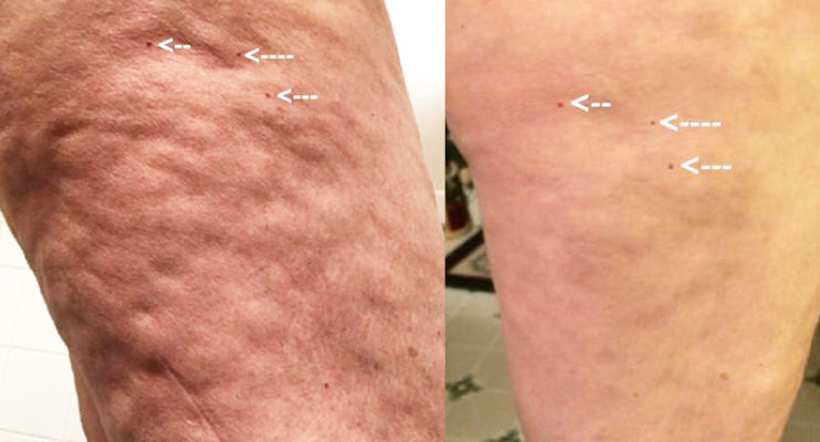 Cellulite Introduction