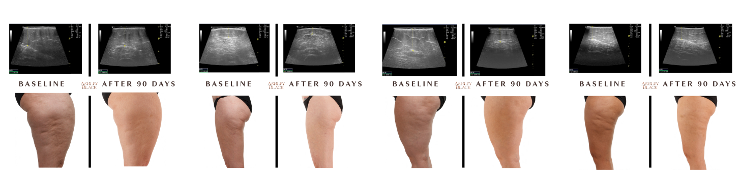 6 Myths About FasciaBlaster Damage & Bruising | Ashley Black