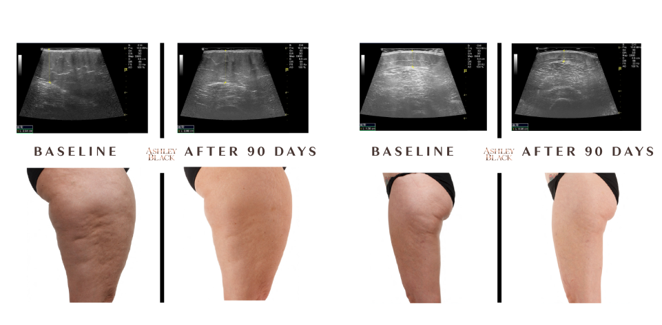 6 Myths About FasciaBlaster Damage & Bruising | Ashley Black