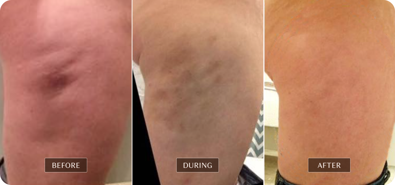 6 Myths About FasciaBlaster Damage & Bruising | Ashley Black