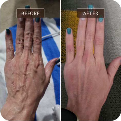 6 Myths About FasciaBlaster Damage & Bruising | Ashley Black