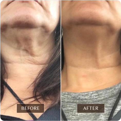 6 Myths About FasciaBlaster Damage & Bruising | Ashley Black