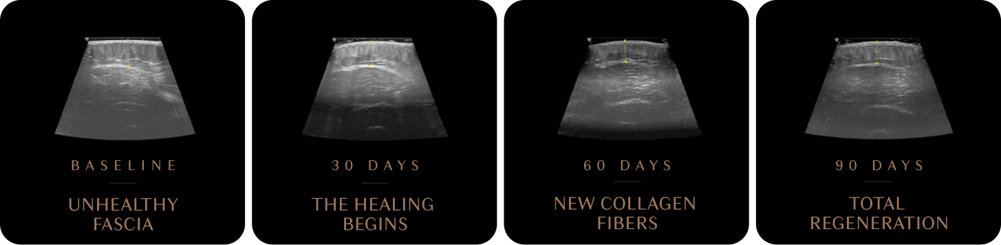 6 Myths About FasciaBlaster Damage & Bruising | Ashley Black